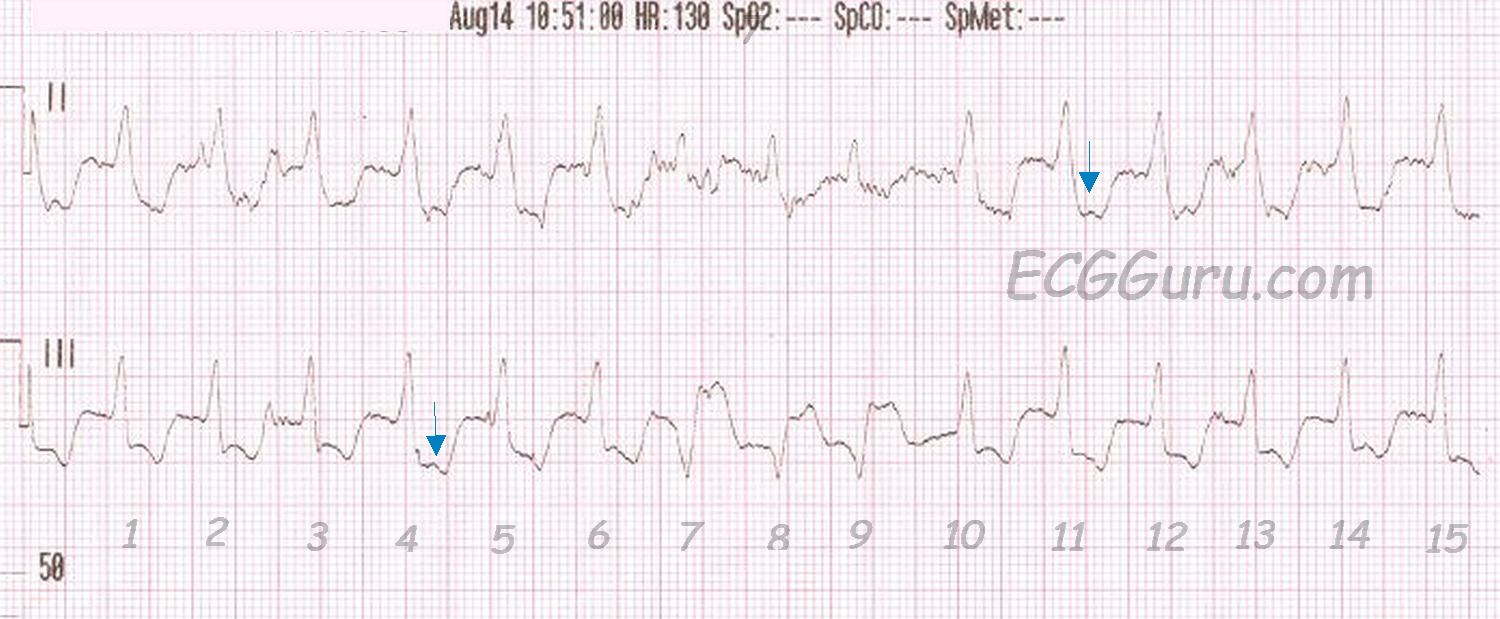 Wide Complex Tachycardia | ECG Guru - Instructor Resources Wide Complex Tachycardia | ECG Guru - Instructor Resources